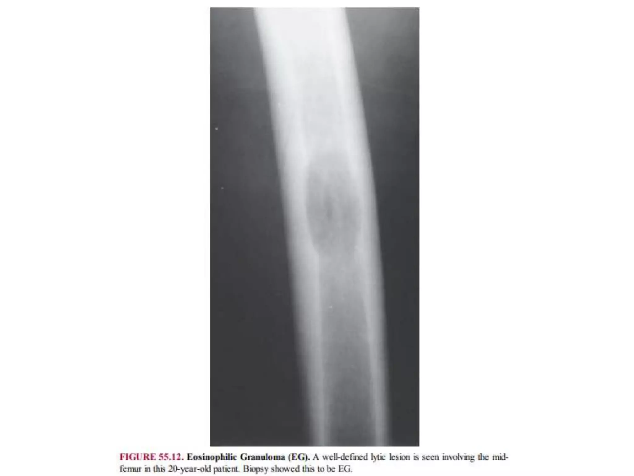 Lytic lesions of bone | PPTX