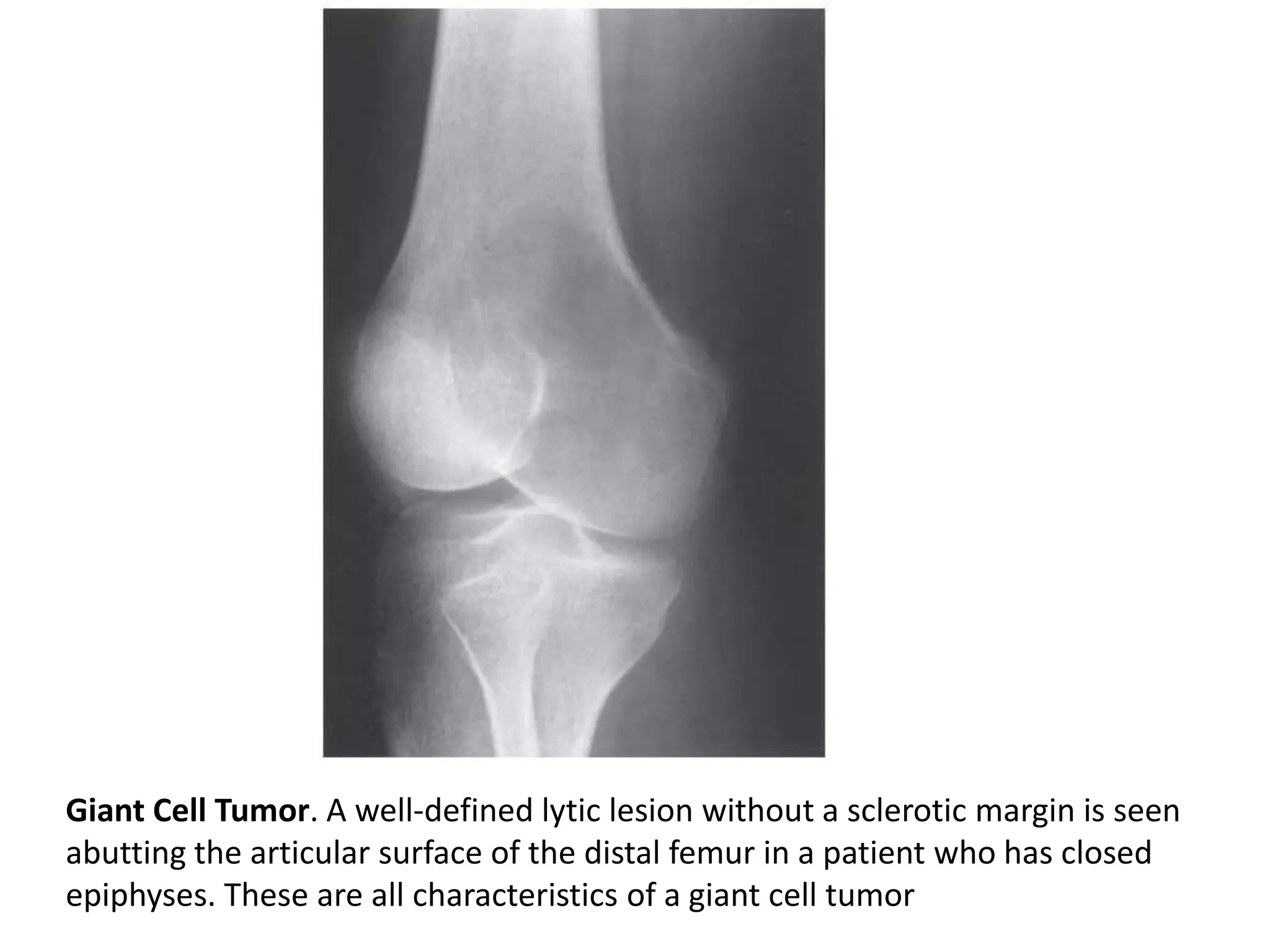 Lytic lesions of bone | PPTX