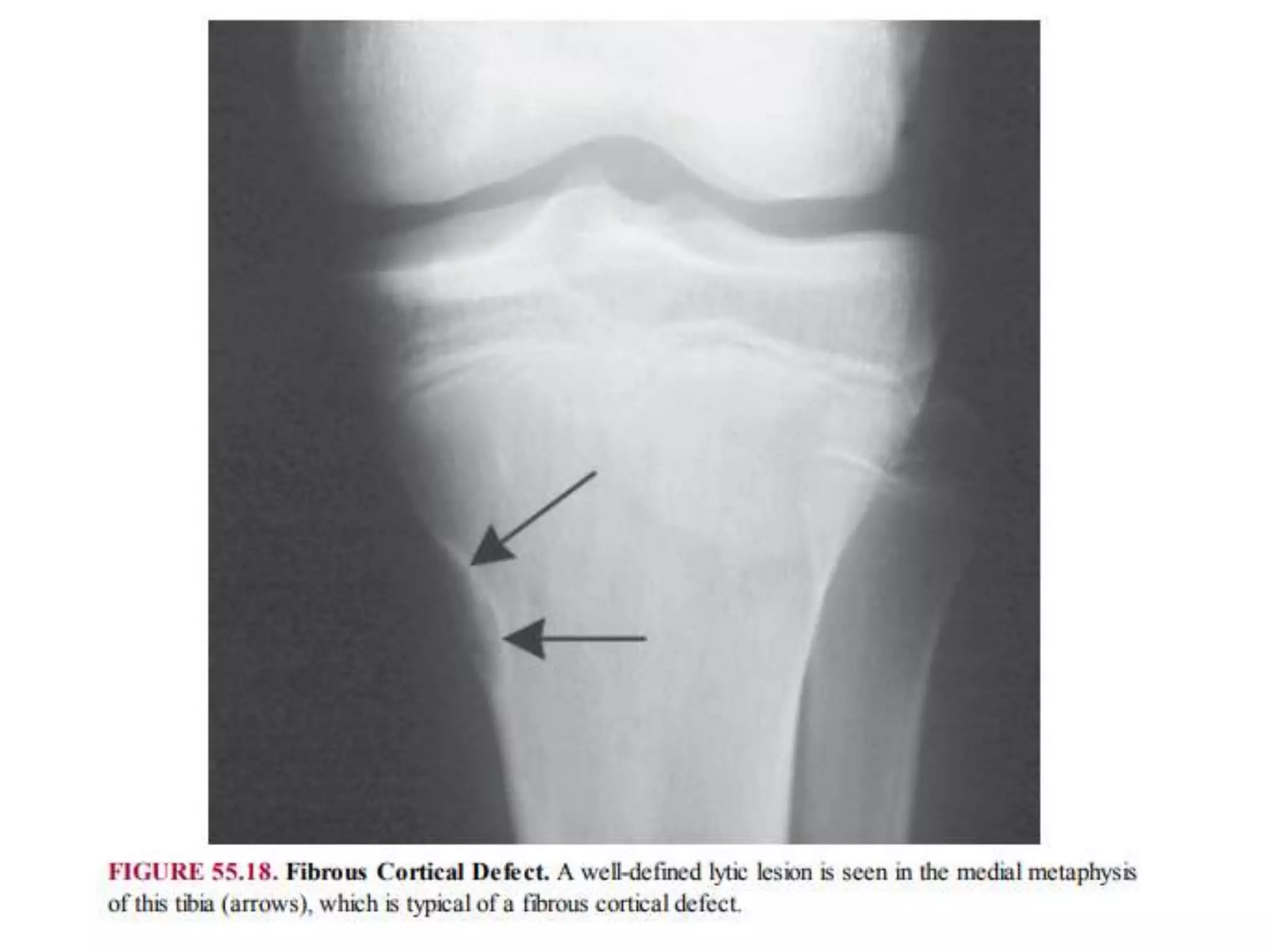 Lytic lesions of bone | PPTX