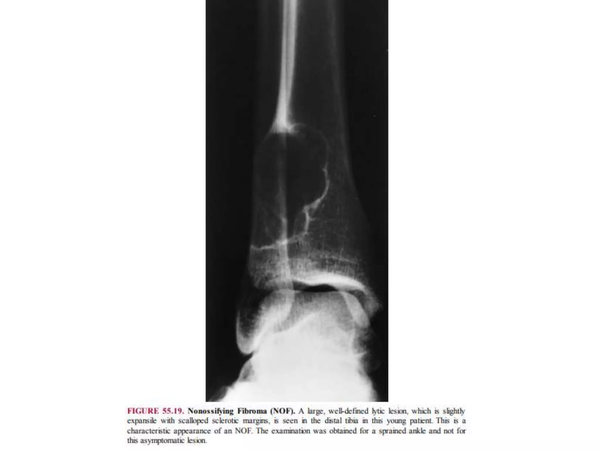Lytic lesions of bone | PPTX