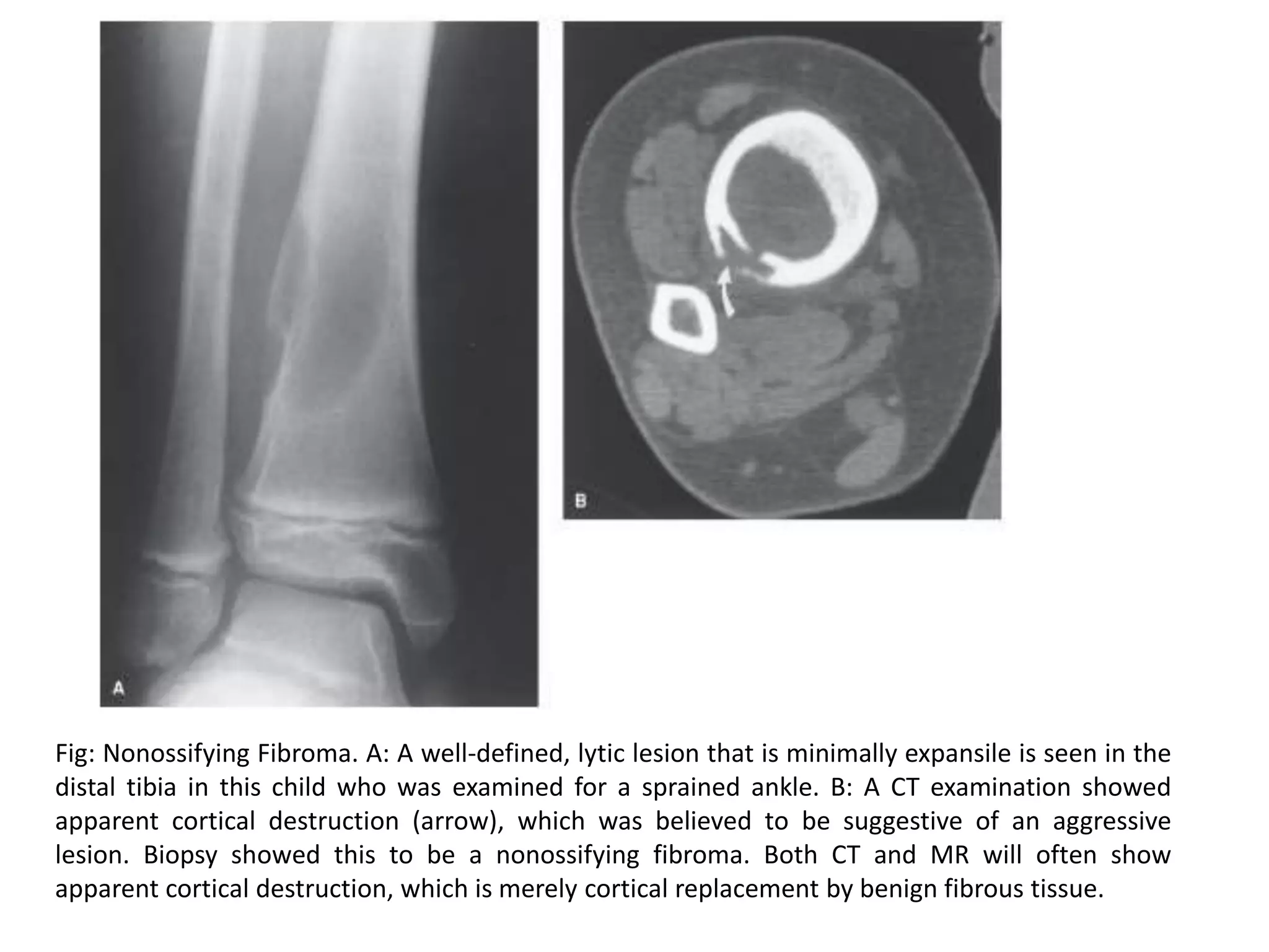 Lytic lesions of bone | PPTX