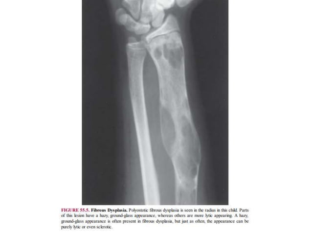 Lytic lesions of bone | PPTX