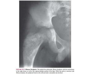 Lytic lesions of bone | PPTX
