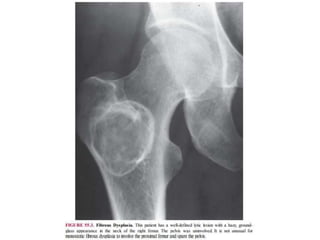 Lytic lesions of bone | PPTX