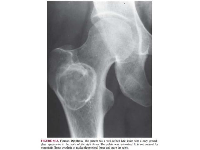Lytic lesions of bone | PPTX