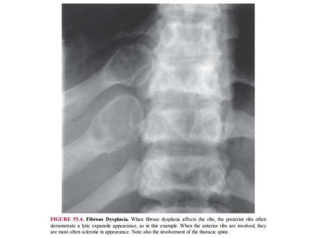 Lytic lesions of bone | PPTX