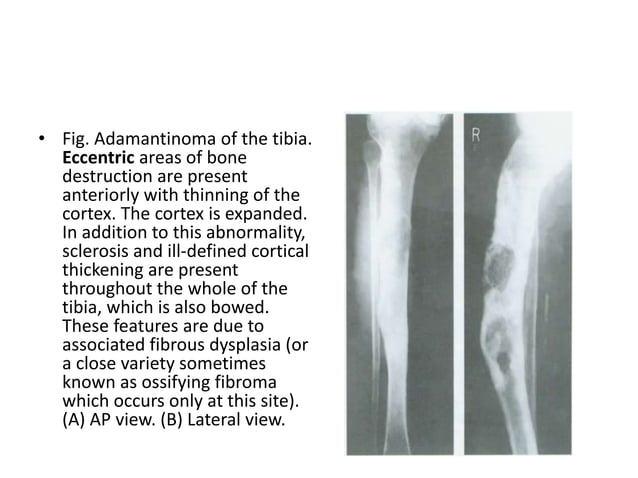 Lytic lesions of bone | PPTX