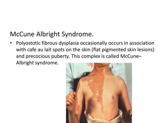 Lytic lesions of bone | PPTX