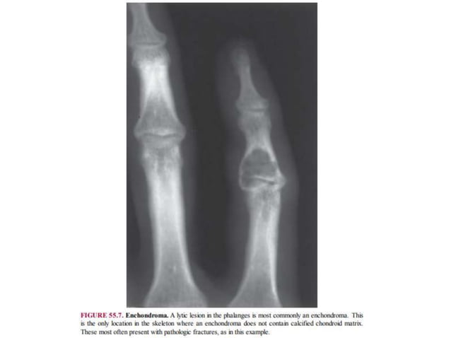Lytic lesions of bone | PPTX