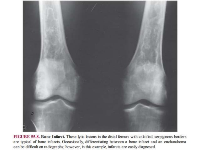 Lytic lesions of bone | PPTX