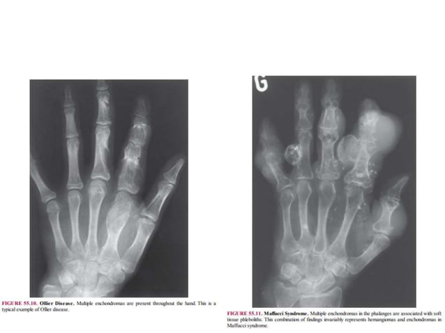 Lytic lesions of bone | PPTX