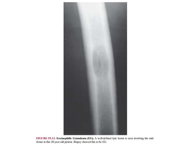 Lytic lesions of bone | PPTX