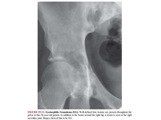 Lytic lesions of bone | PPTX