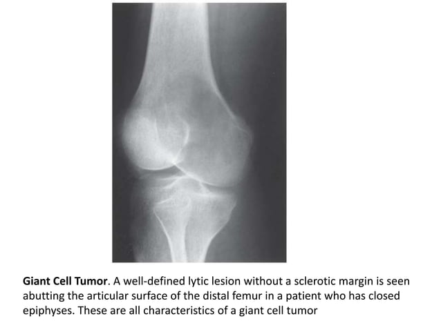 Lytic lesions of bone | PPTX