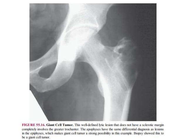 Lytic lesions of bone | PPTX