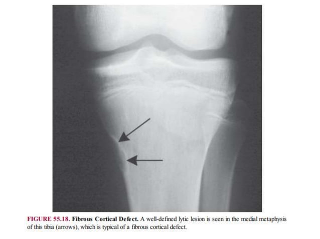 Lytic lesions of bone | PPTX