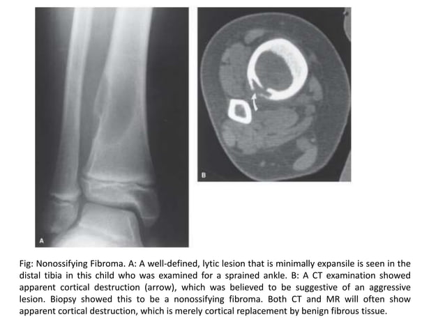 Lytic lesions of bone | PPTX
