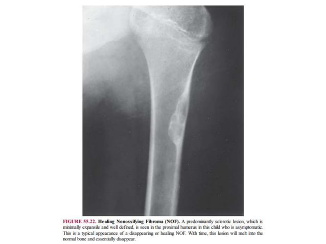 Lytic lesions of bone | PPTX