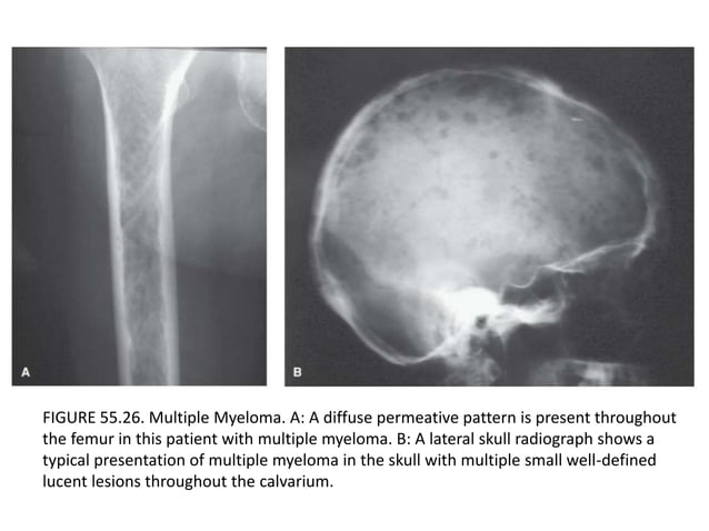 Lytic lesions of bone | PPTX