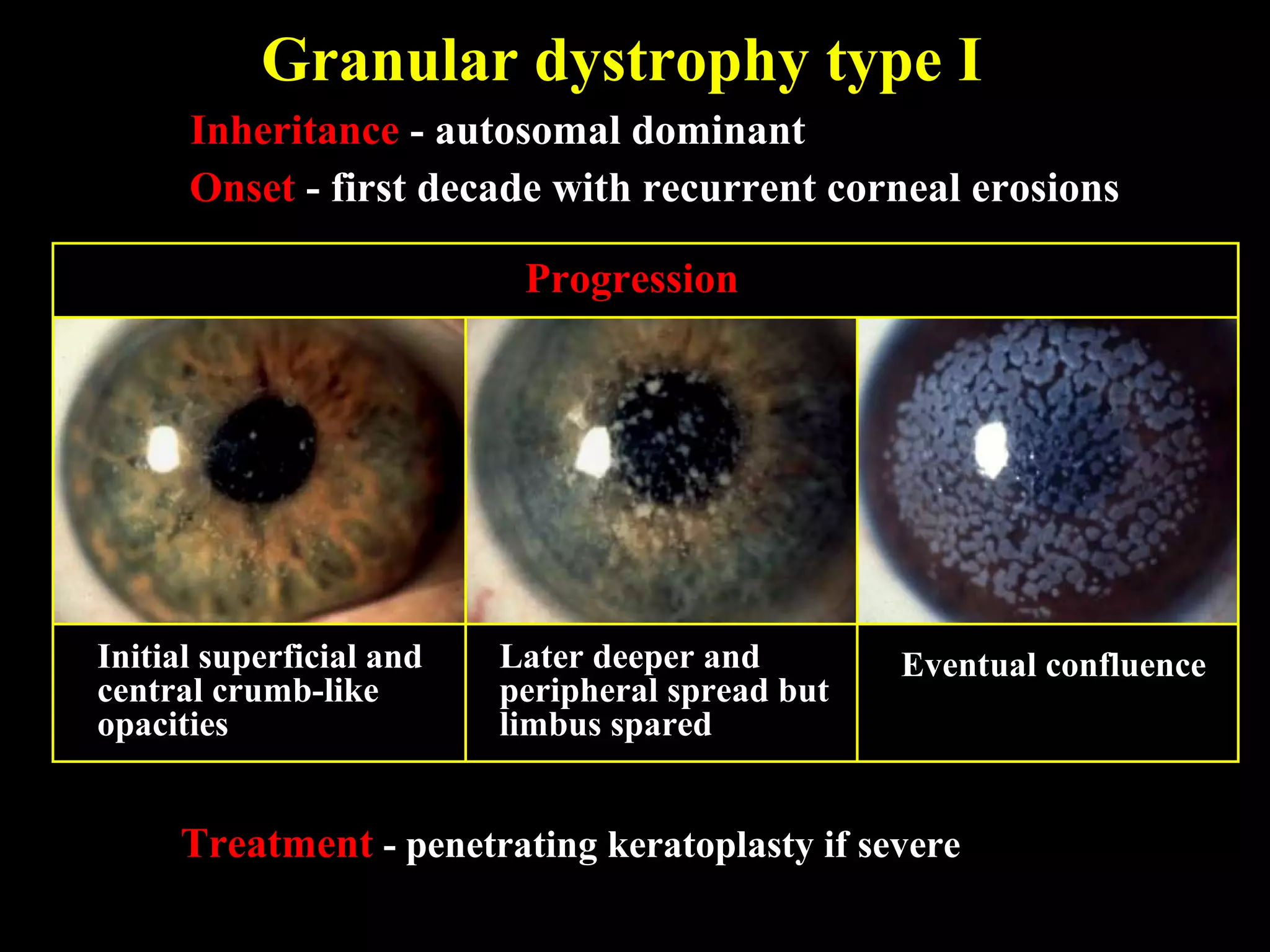 17 corneal dystrophies | PPT