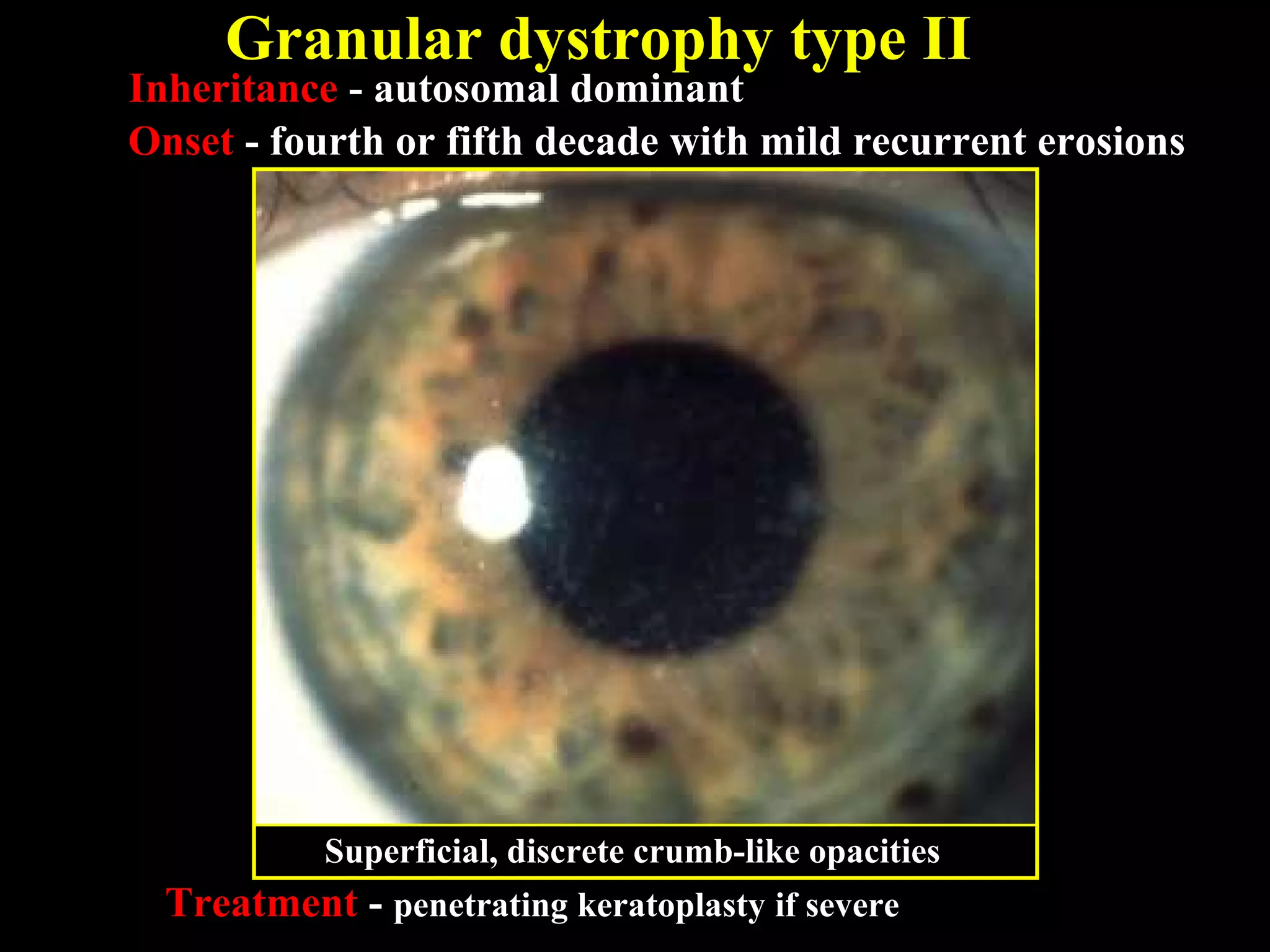 17 corneal dystrophies | PPT