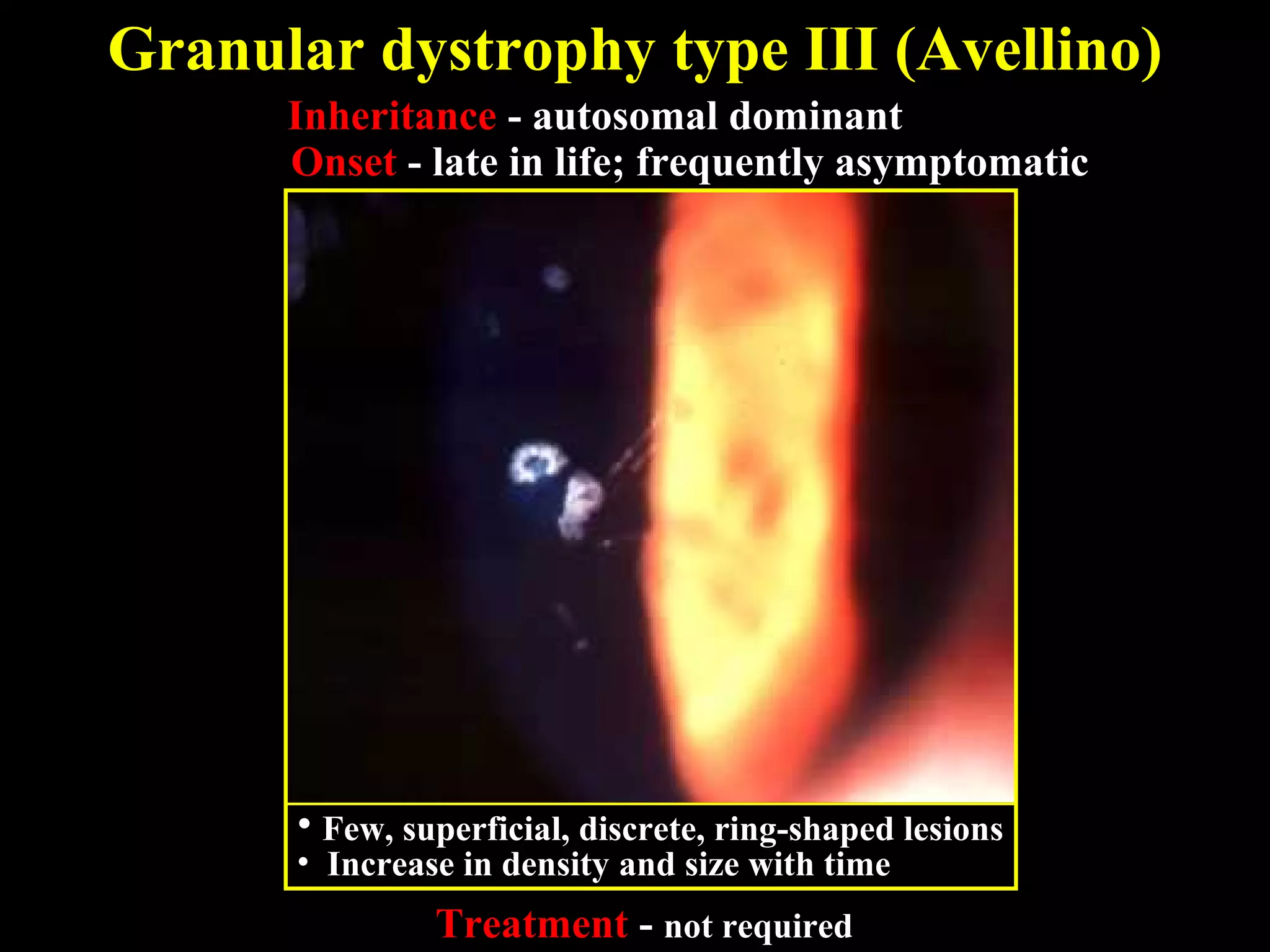 17 corneal dystrophies | PPT