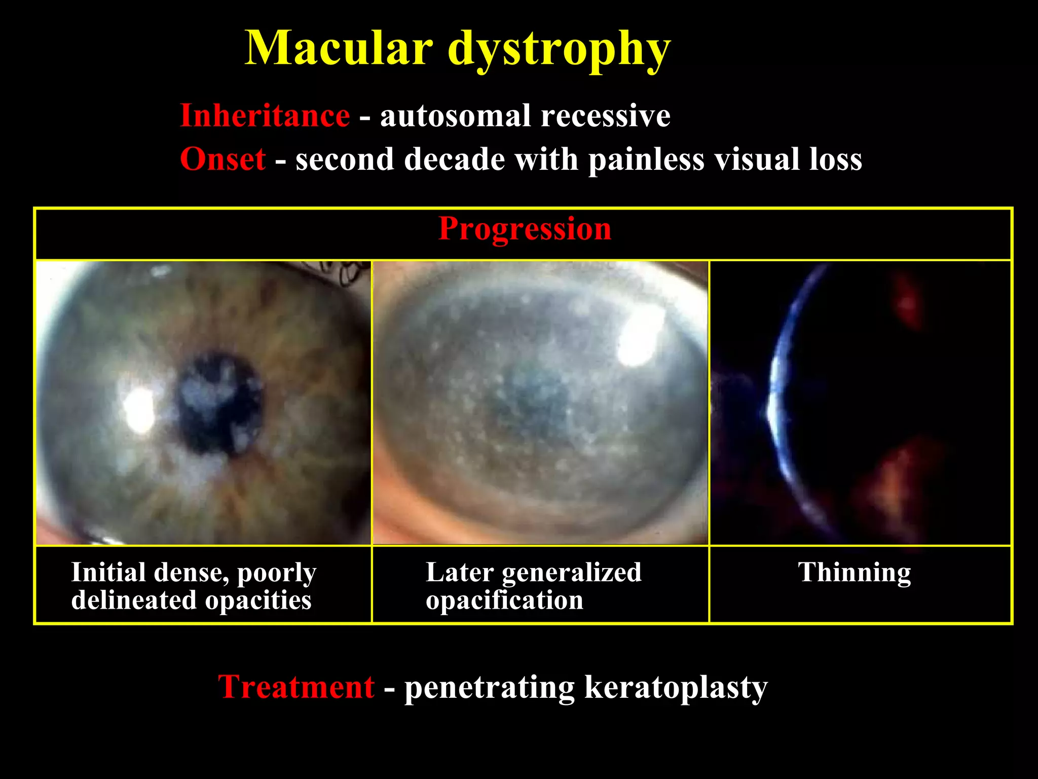 17 corneal dystrophies | PPT