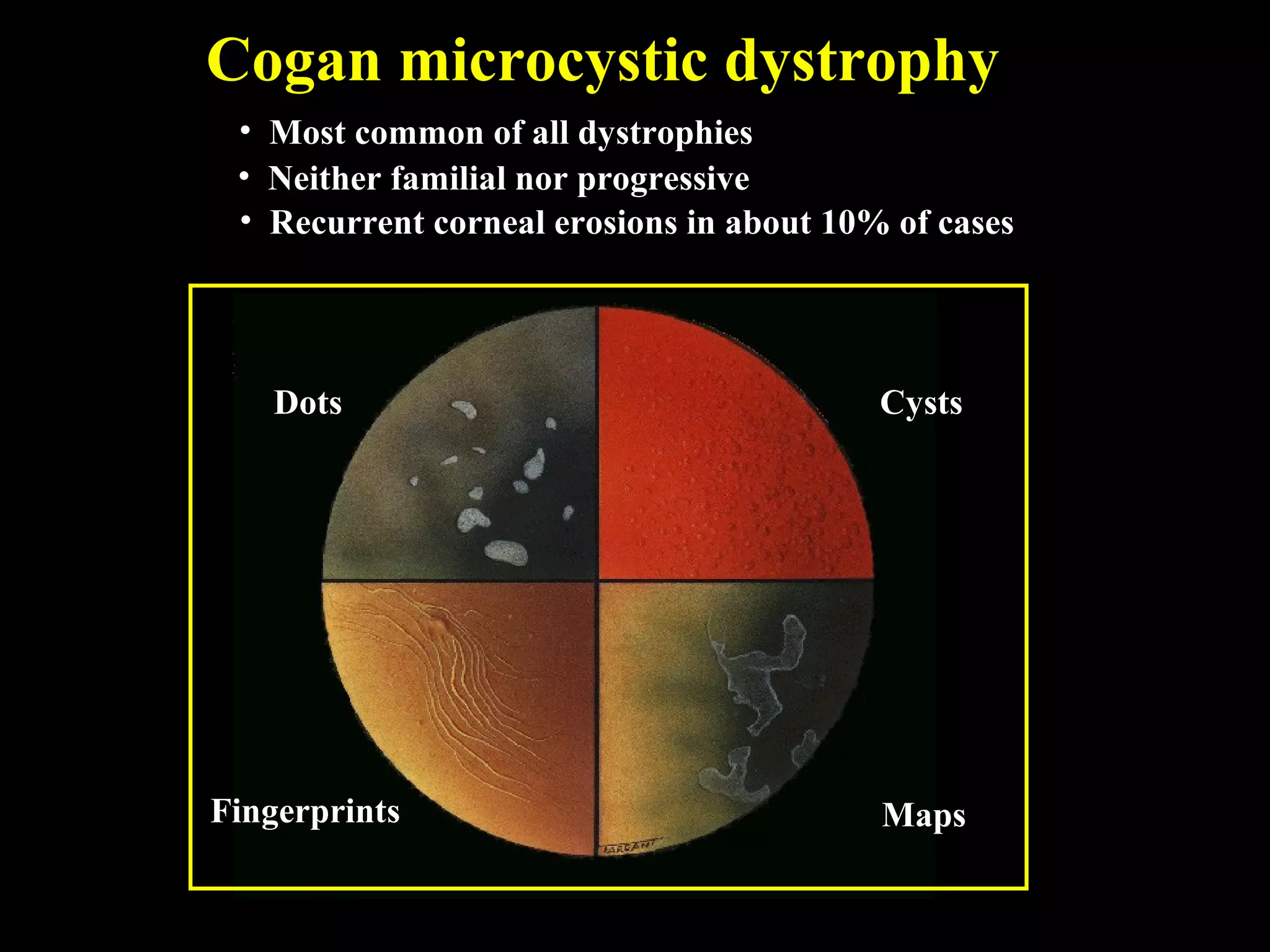 17 corneal dystrophies | PPT