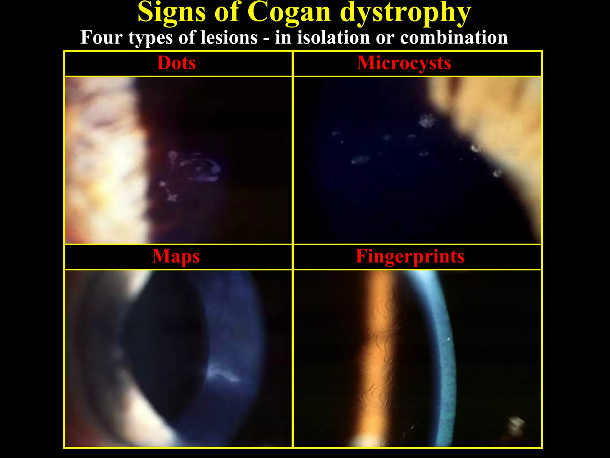 17 corneal dystrophies | PPT