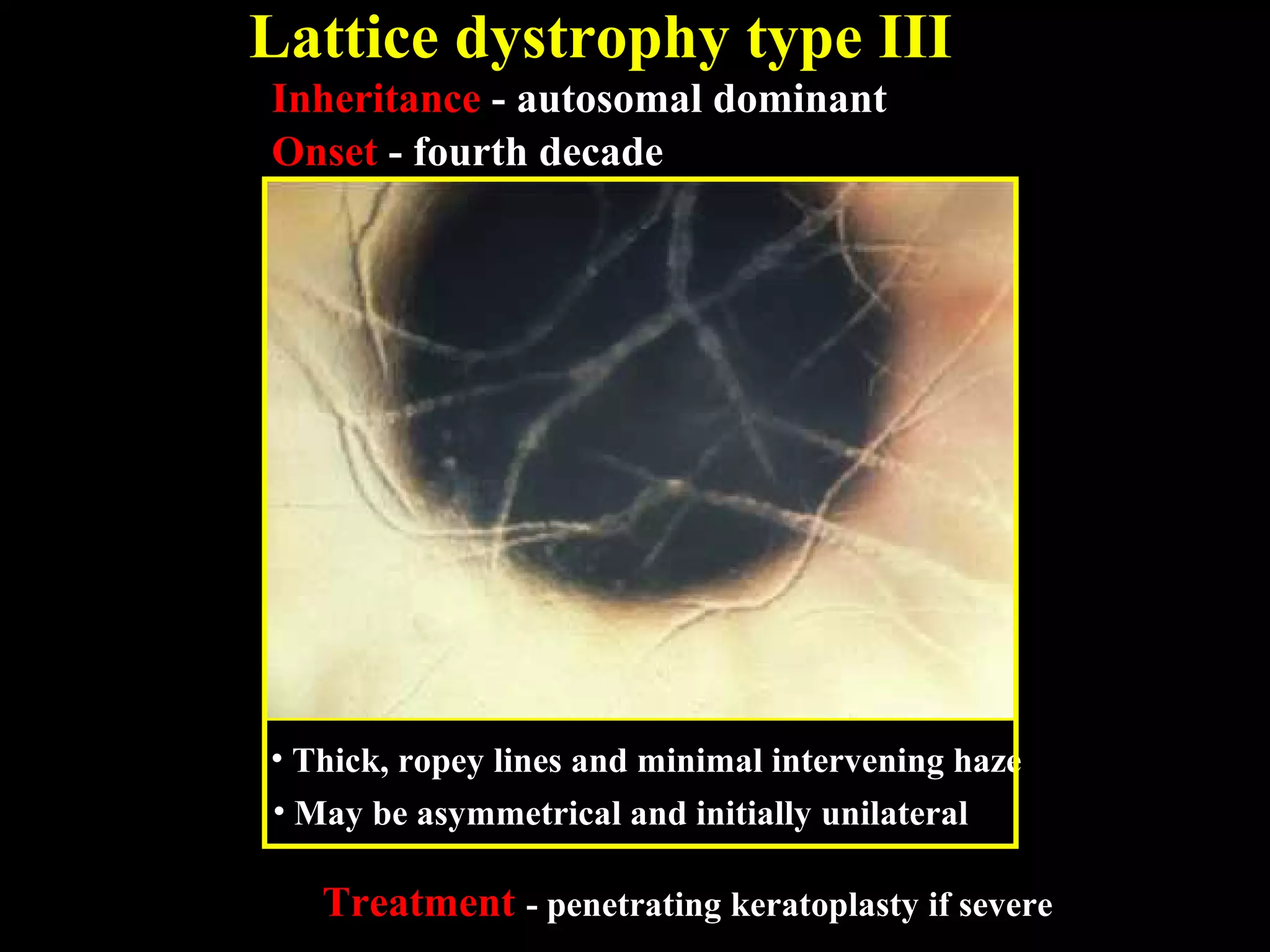 17 corneal dystrophies | PPT