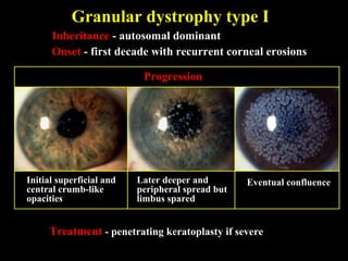 17 corneal dystrophies | PPT
