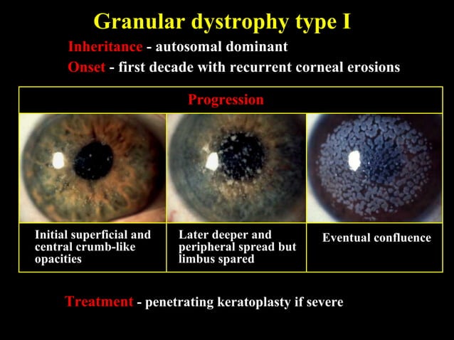 17 corneal dystrophies | PPT