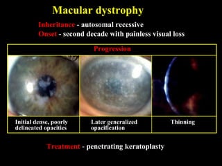 Macular Corneal Dystrophy