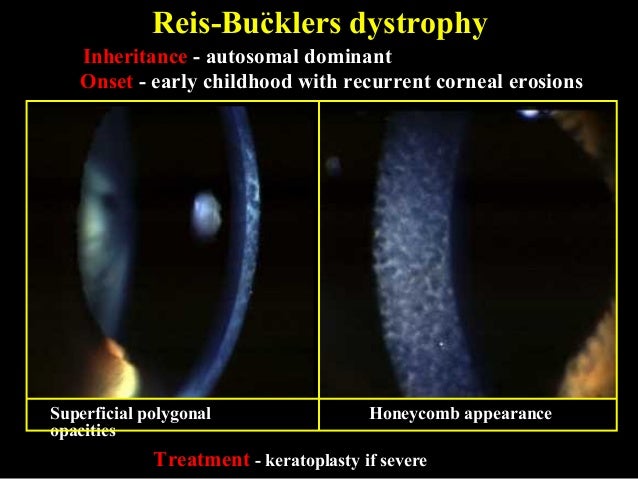 17 corneal dystrophies