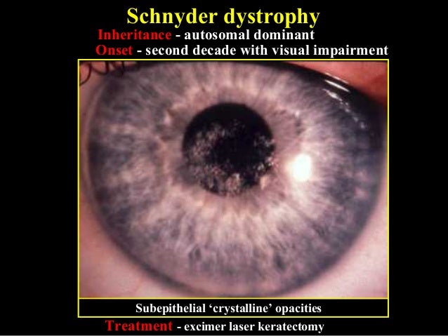 17 corneal dystrophies