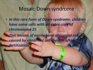 DOWNS SYNDROME (PPT) | PPTX