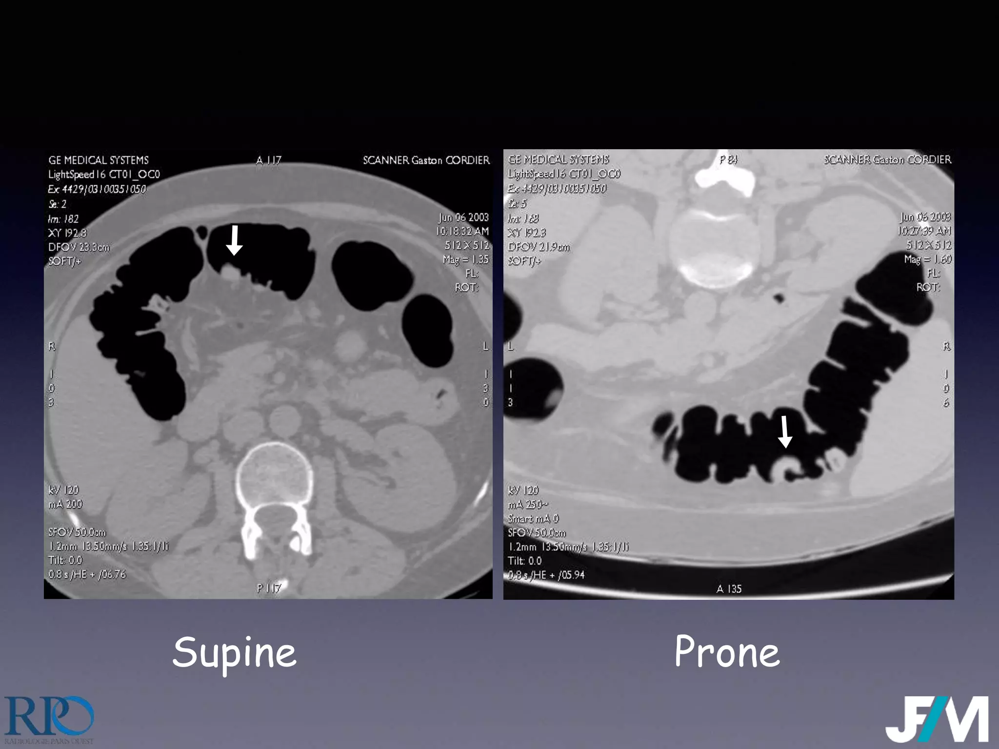 Mehdi Cadi CT colonography Jfim Buenos-Aires 2017 | PPT