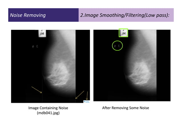 MICROCALCIFICATION IDENTIFICATION IN DIGITAL MAMMOGRAM FOR EARLY ...