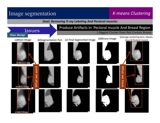 MICROCALCIFICATION IDENTIFICATION IN DIGITAL MAMMOGRAM FOR EARLY ...