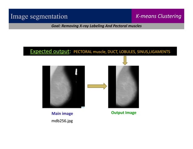 MICROCALCIFICATION IDENTIFICATION IN DIGITAL MAMMOGRAM FOR EARLY ...