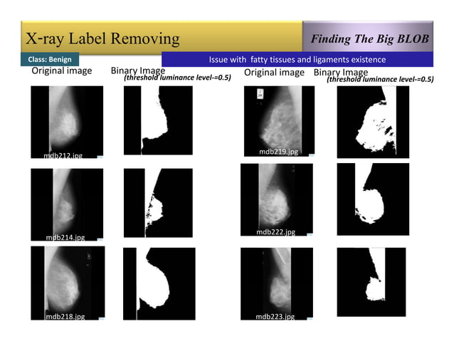 MICROCALCIFICATION IDENTIFICATION IN DIGITAL MAMMOGRAM FOR EARLY ...