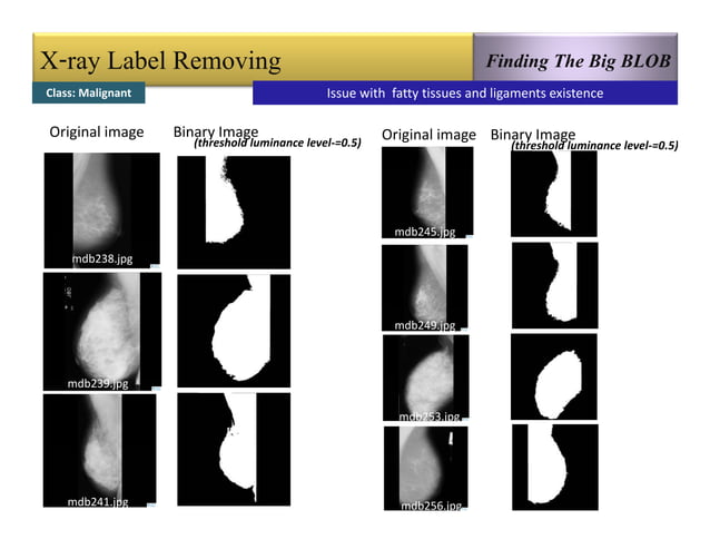 MICROCALCIFICATION IDENTIFICATION IN DIGITAL MAMMOGRAM FOR EARLY ...