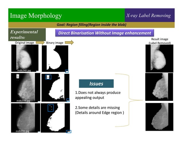 Microcalcification Identification In Digital Mammogram For Early Detection Of Breast Cancer Ppt