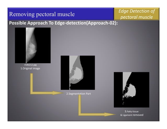 MICROCALCIFICATION IDENTIFICATION IN DIGITAL MAMMOGRAM FOR EARLY ...