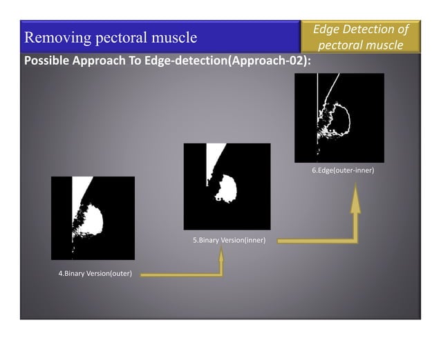 Microcalcification Identification In Digital Mammogram For Early