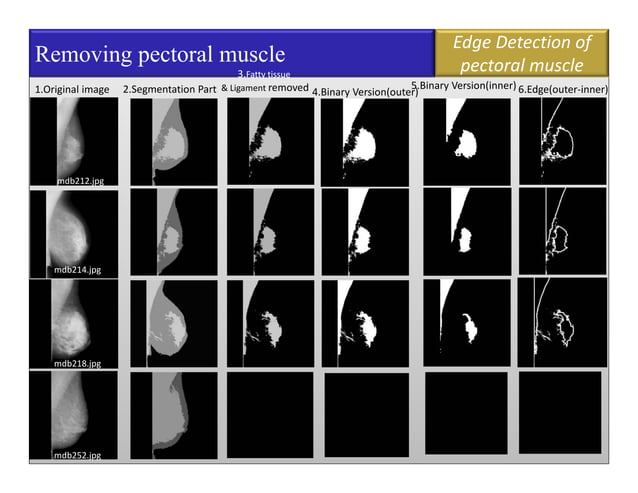 MICROCALCIFICATION IDENTIFICATION IN DIGITAL MAMMOGRAM FOR EARLY DETECTION OF BREAST CANCER | PPT