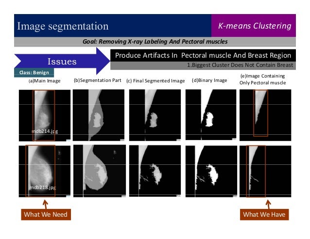 Microcalcification Identification In Digital Mammogram For Early Dete…