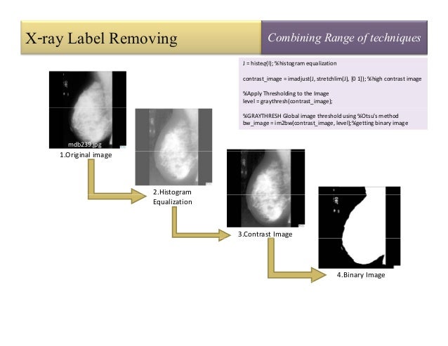 MICROCALCIFICATION IDENTIFICATION IN DIGITAL MAMMOGRAM FOR EARLY DETE…