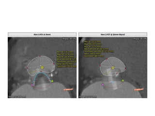 STEP BY STEP VALVE IN VALVE TMVR | PPTX