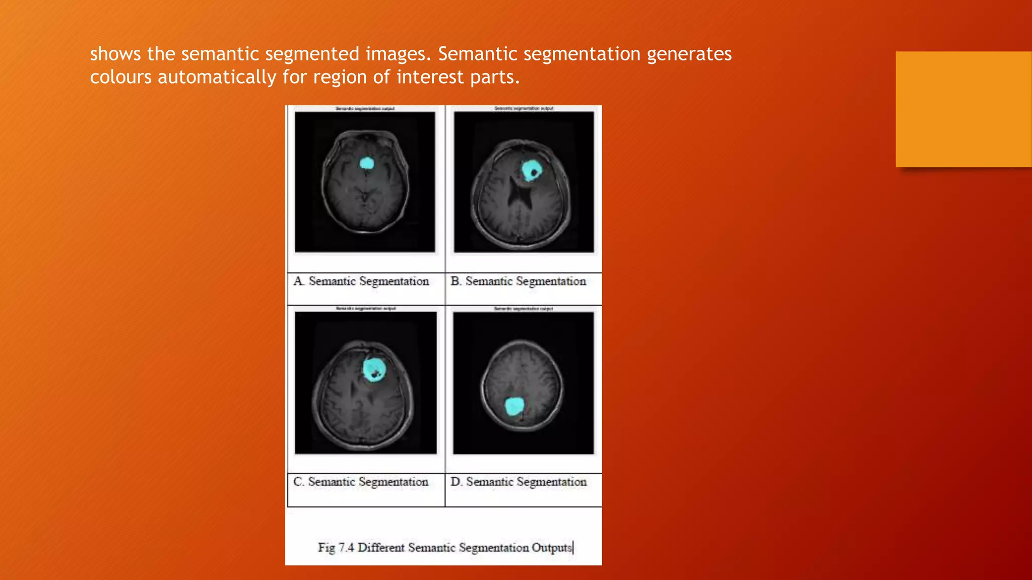 A DEEP LEARNING APPROACH FOR SEMANTIC SEGMENTATION IN BRAIN TUMOR IMAGES | PPTX